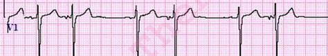 Premature Atrial Contractions Pacs Ecg Review Criteria And Examples