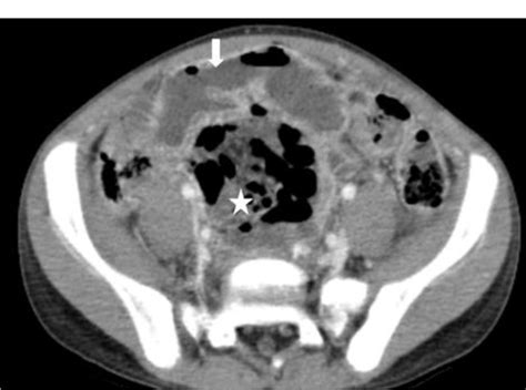 Figure 5 From Small Bowel Obstruction In Infants Due To Complicated Meckels Diverticulum A