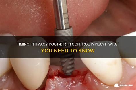 Timing Intimacy Post Birth Control Implant What You Need To Know