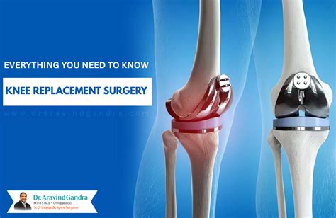 Knee Replacement Surgery Everything You Need To Know