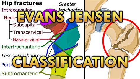 Evans Hip Fracture Classification