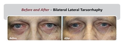 Poor Eyelid Closure Lagophthalmos Triad Eye Institute