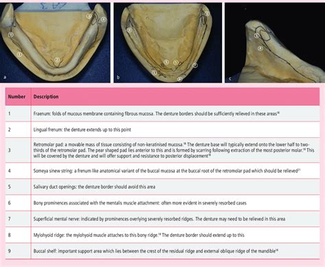 Mandibular Landmarks Of Interest And An Outline Of The Denture Base A