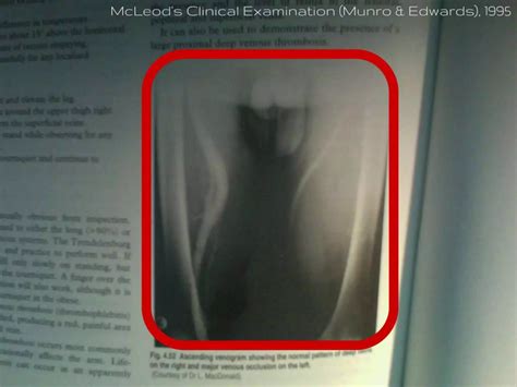 Distal Dvt Should We Treat Pptx