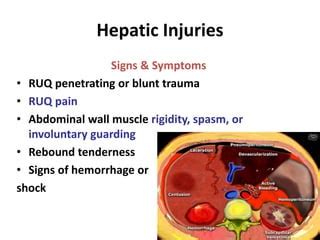 Abdominal Injuries In Sportspptx