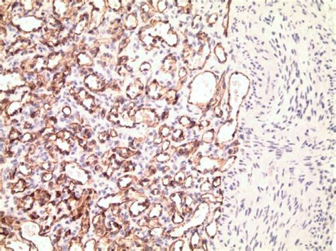Immunohistochemical Staining For Cd31 Is Strongly Positive In The Download Scientific Diagram