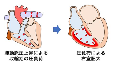 心室中隔欠損症とは 心電図com