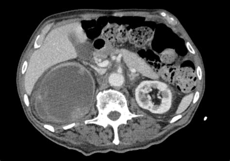 Intern Ultrasound Of The Month A Rare Complex Cystic Renal Mass