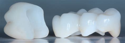 Dental Crowns And Bridges All You Need To Know