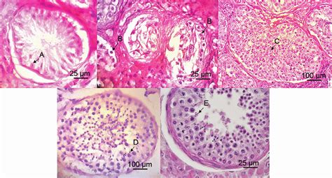 Five Testicular Histopathological Patterns Based On Spermatogenesis
