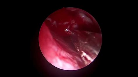 Dr Supriya Chauhan On Linkedin Endoscopicsurgery Neurosurgery