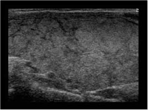 Thyroid Ultrasound Sonographic Tendencies