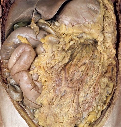 Cadaver Dissection Stock Image Science Source Images