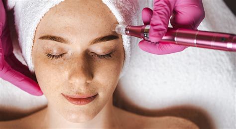 Dermapen Microneedling With Harley Street Pro Pen 3 In Coventry Astounding Skin Aesthetics