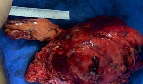 Right Radical Nephrectomy Specimen With Tumor Thrombus Download Scientific Diagram
