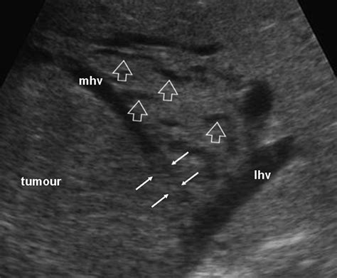 Sonography Of Budd Chiari Syndrome Ajr