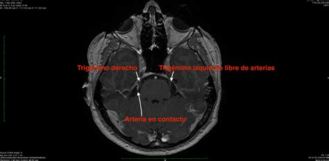 Neuralgia Del Trigémino Resonancia Magnética