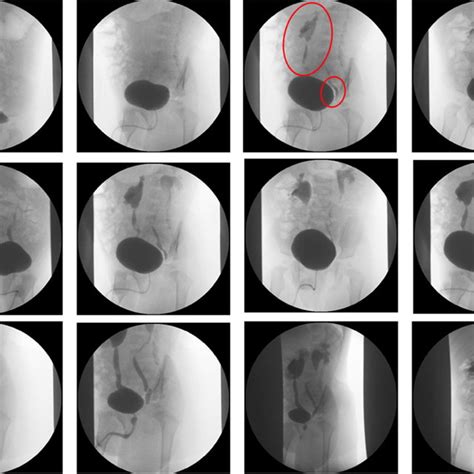 Example Of A Voiding Cystourethrogram Vcug Report Shown To Reviewers