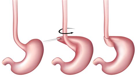 Laparoscopic Fundoplication