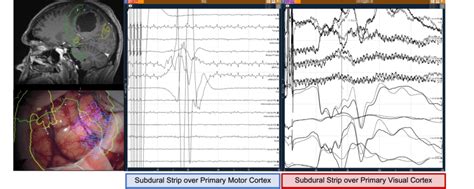 Example Of A Craniotomy For Tumour Resection With Simultaneously Motor