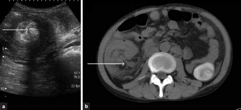 A Ultrasound Image Showing The Echogenic Mesenteric Fat Arrow