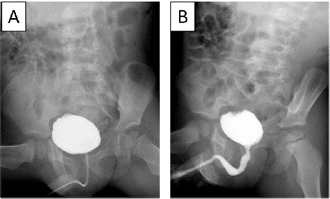 Postoperative Voiding Cystourethrography Shows A No Vesicoureteral