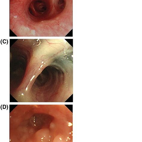 Bronchoscopy Of Chronic Eosinophilic Pneumonia A Bronchoscopy