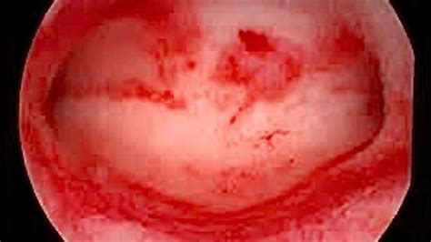 Histeroscopia Clinica De Reprodução Humana