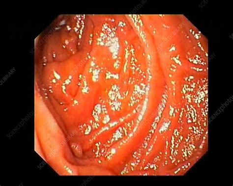 Human Duodenum Endoscope View Stock Video Clip K0013638 Science