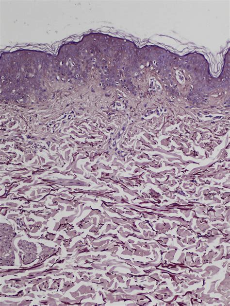 Papular Elastorrhexis And Buschkeollendorff Syndrome Are Different