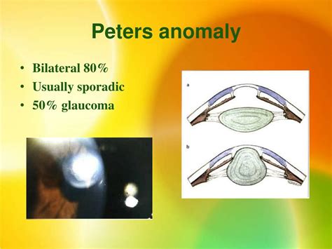 Ppt The Congenital Developmental Glaucomas Powerpoint Presentation