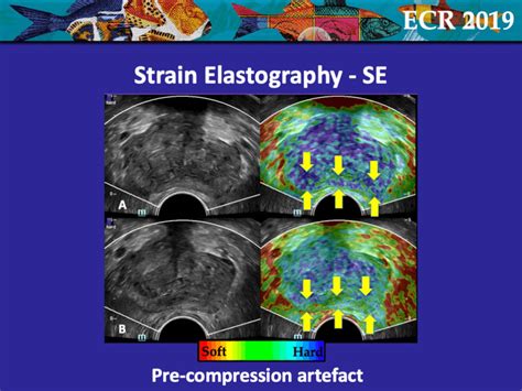 Pre Compression Artefact At Se A The Peripheral Zone Compression Download Scientific Diagram