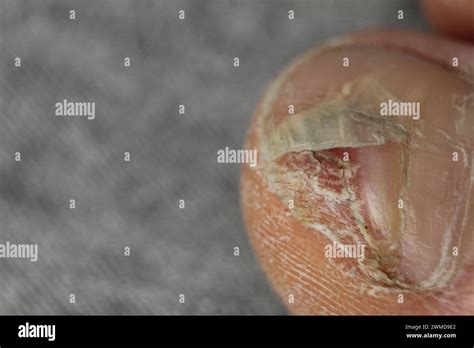 Fungal Diseases Of The Nails And Skin Of The Feet Close Up Podology