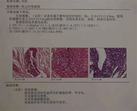 肝癌病理报告解读，了解这些术语和缩略语才能更好地了解病情马大军副主任医师爱问健康