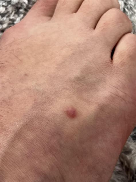 Cellular Dermatofibroma Rmedicalcuriosities