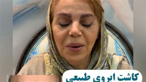 کاشت ابروی طبیعی روی بخیه