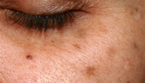 Effective Treatments For Pigmentation In Toowoomba