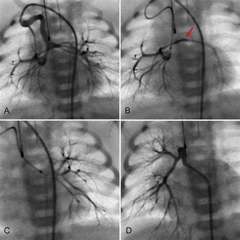 Outcomes After Initial Unifocalization To A Shunt In Complex Tetralogy