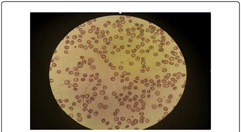 Microcytosis With Target Cells In Cytomorphological Examination Of