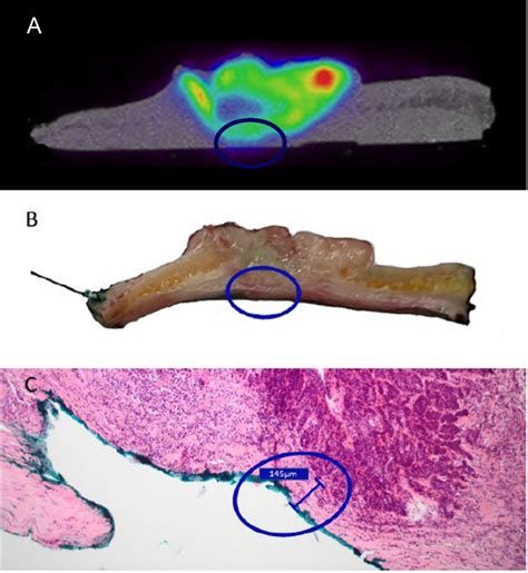 Imaging Case 6 Head And Neck Squamous Cell Carcinoma Of The Scalp International English