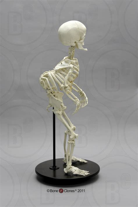 Achondroplasia Dwarfism Skeleton