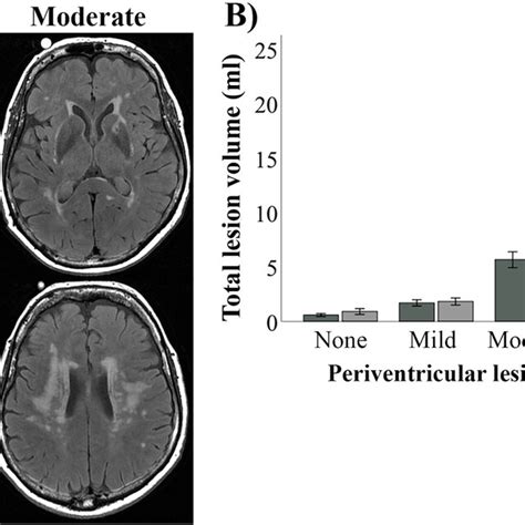 White Matter Lesion Severity Large Individual Differences In Lesion