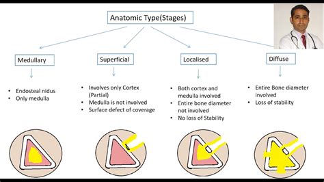 Classification Of Chronic Osteomyelitis Cierney Mader Classification Youtube
