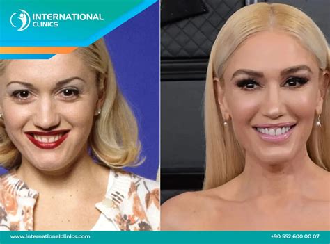 Gwen Stefani Plastic Surgery Journey 2026