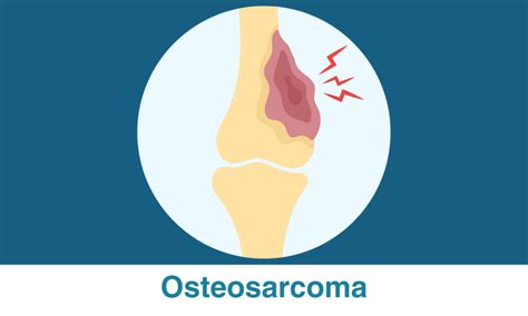 What Is Osteosarcoma Proton Therapy