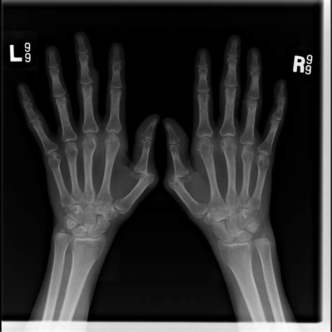 Ra Hands Rheumexam Atlas
