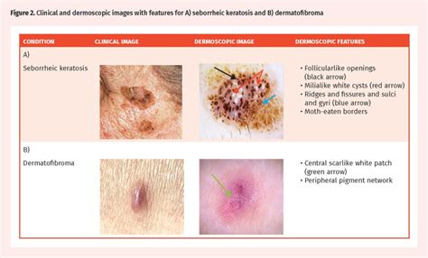 Dermatoscopy Findings Gp Exams