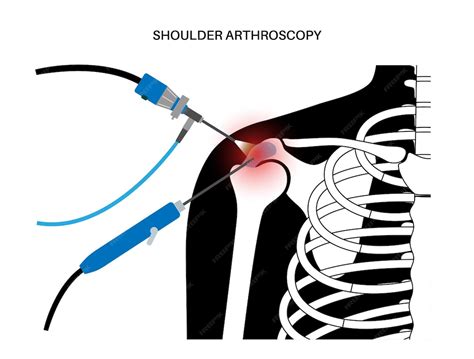 Premium Vector Shoulder Arthroscopy Procedure Rotator Cuff Tears Or