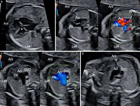 Prenatal Screening And Diagnosis Of Pulmonary Artery Anomalies