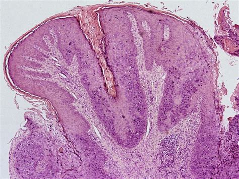 Buschke Lowenstein Tumor Gard Rare Disease Information Tsukl